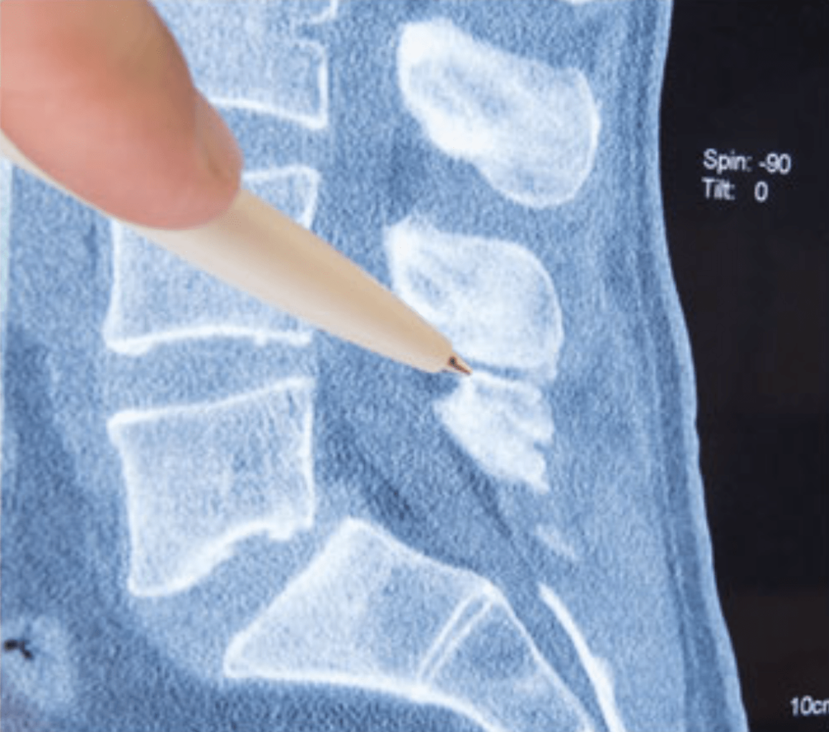 MINIMALLY INVASIVE LAMINECTOMY - Texas Spine Care Center