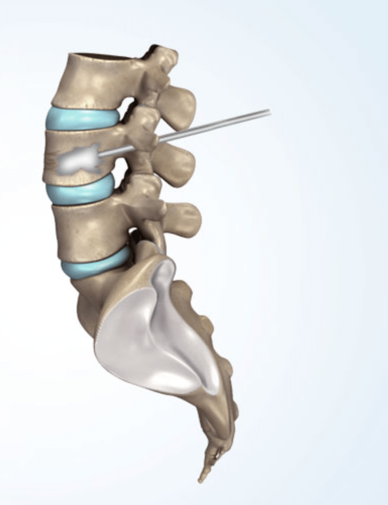VERTEBROPLASTY AND KYPHOPLASTY - Texas Spine Care Center