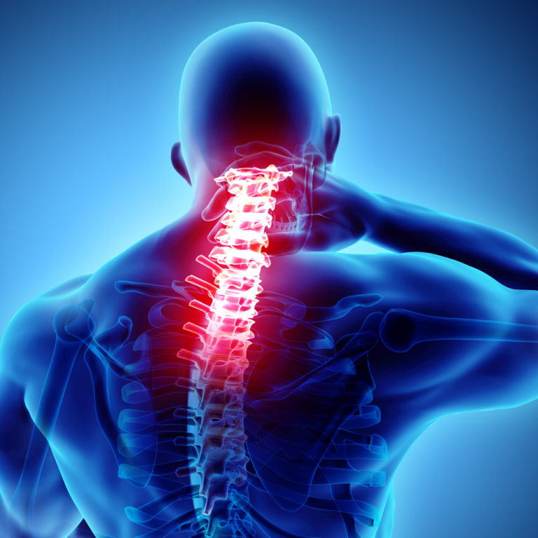 POSTERIOR CERVICAL DECOMPRESSION - Texas Spine Care Center