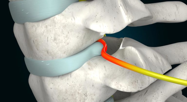 PINCHED NERVE - Texas Spine Care Center