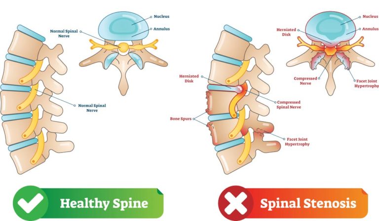 FORAMINAL STENOSIS - Texas Spine Care Center